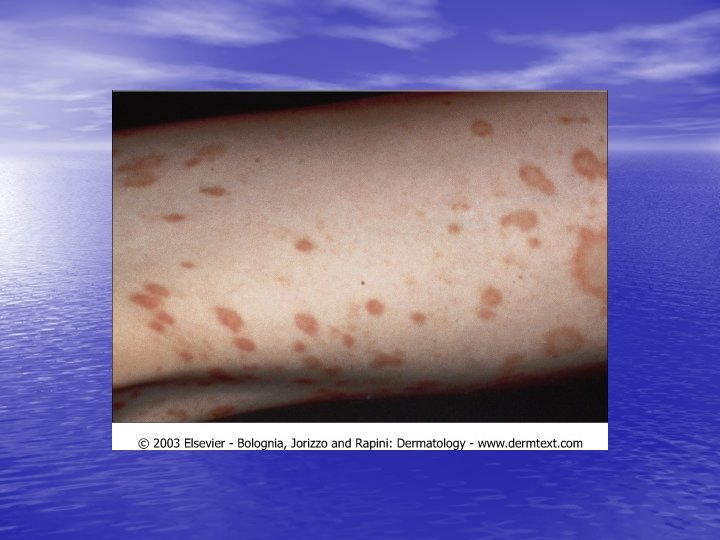 PAPULOSQUAMOUS DISEASES I Pityriasis rosea Lichen planus PITYRIASIS