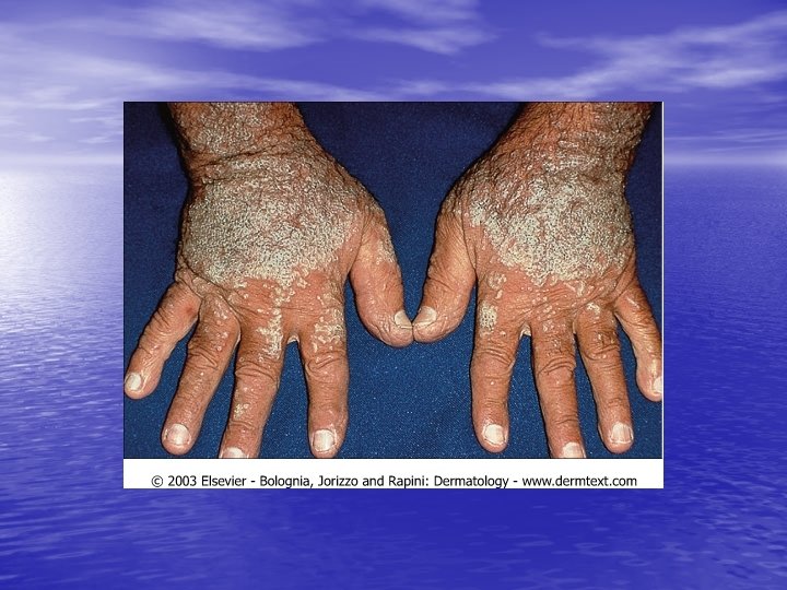 PAPULOSQUAMOUS DISEASES I Pityriasis rosea Lichen planus PITYRIASIS