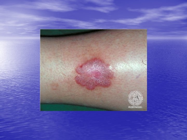 PAPULOSQUAMOUS DISEASES I Pityriasis rosea Lichen planus PITYRIASIS