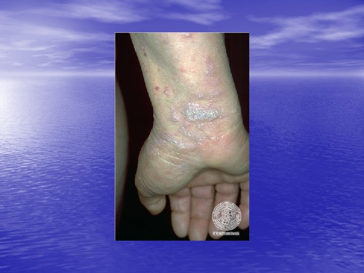 PAPULOSQUAMOUS DISEASES I Pityriasis rosea Lichen planus PITYRIASIS