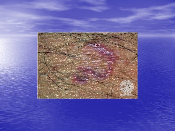 PAPULOSQUAMOUS DISEASES I Pityriasis rosea Lichen planus PITYRIASIS