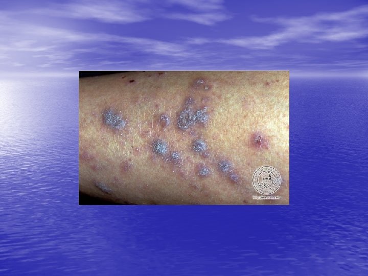 PAPULOSQUAMOUS DISEASES I Pityriasis rosea Lichen planus PITYRIASIS