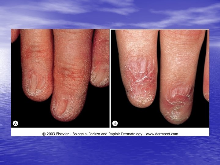 PAPULOSQUAMOUS DISEASES I Pityriasis rosea Lichen planus PITYRIASIS
