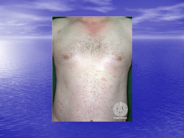 PAPULOSQUAMOUS DISEASES I Pityriasis rosea Lichen planus PITYRIASIS