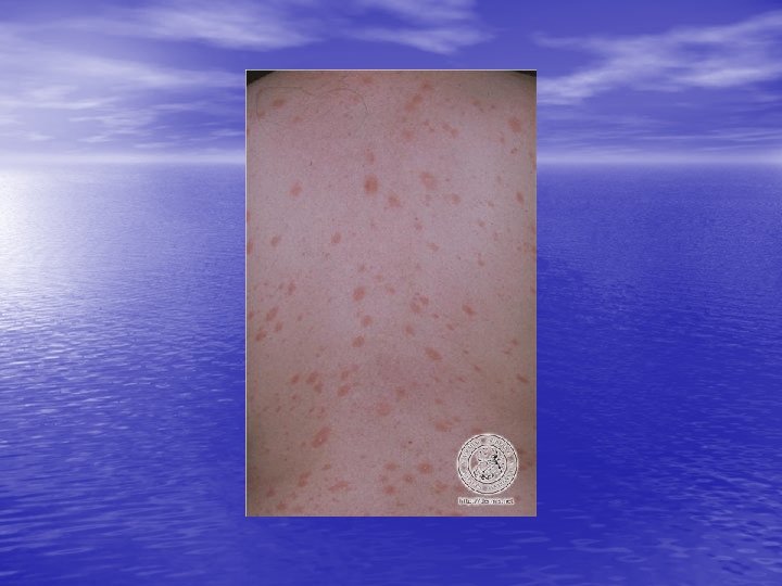 PAPULOSQUAMOUS DISEASES I Pityriasis rosea Lichen planus PITYRIASIS