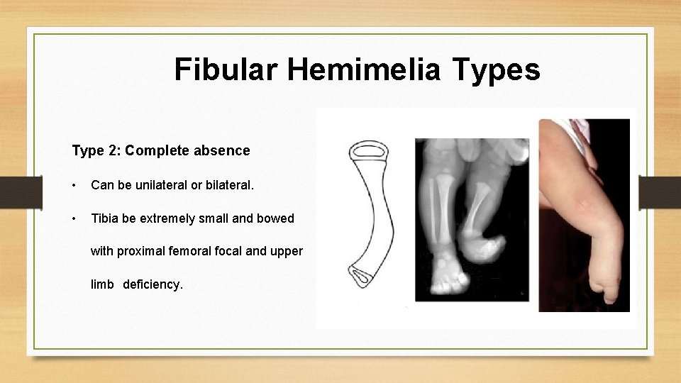 Group 3 Fibular Hemimelia Alina Bodea Co Presenter
