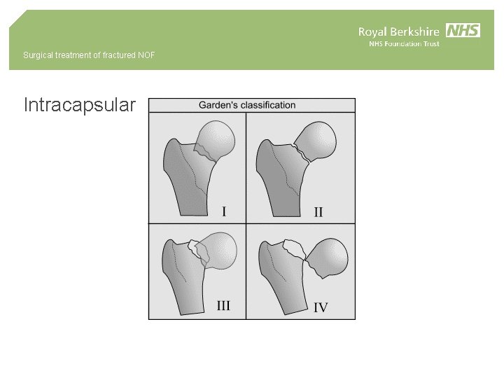 Surgical treatment of fractured hip Neck of femur