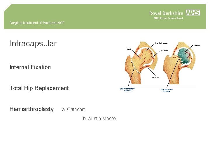 Surgical treatment of fractured hip Neck of femur