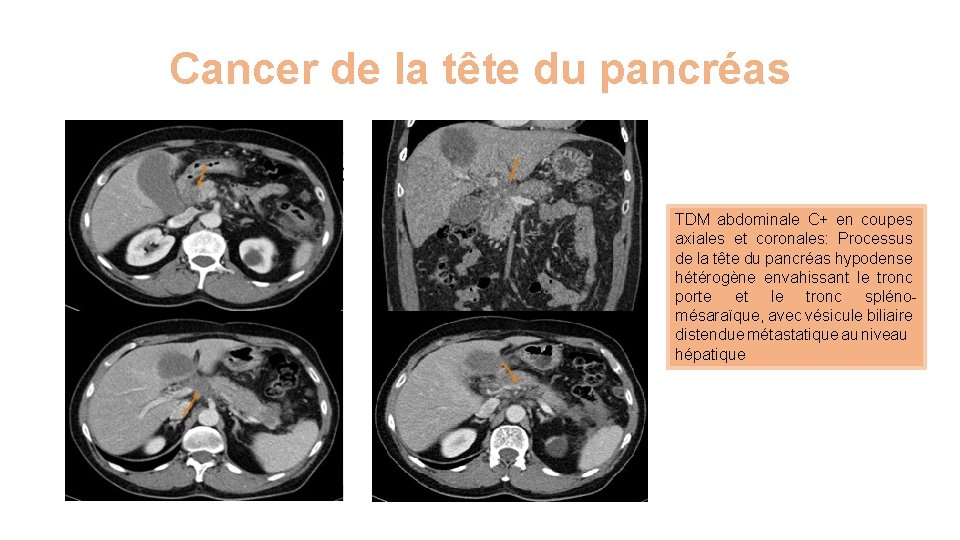 APPORT DE LIMAGERIE DANS LES ICTERES OBSTRUCTIFS NEOPLASIQUE