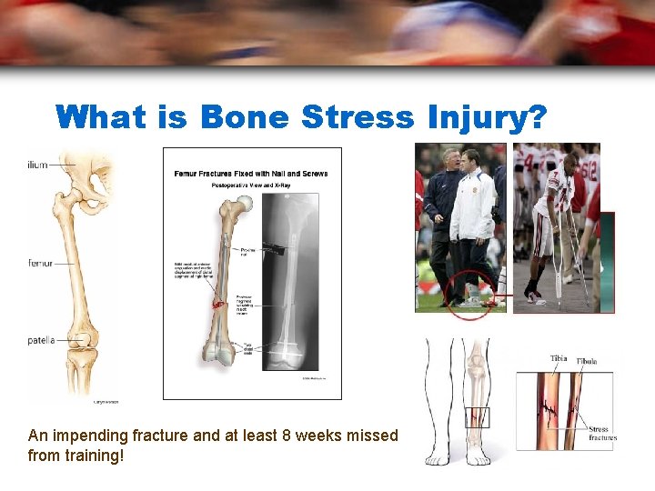 Risk Factors for Bone Stress Injuries Dr Leon