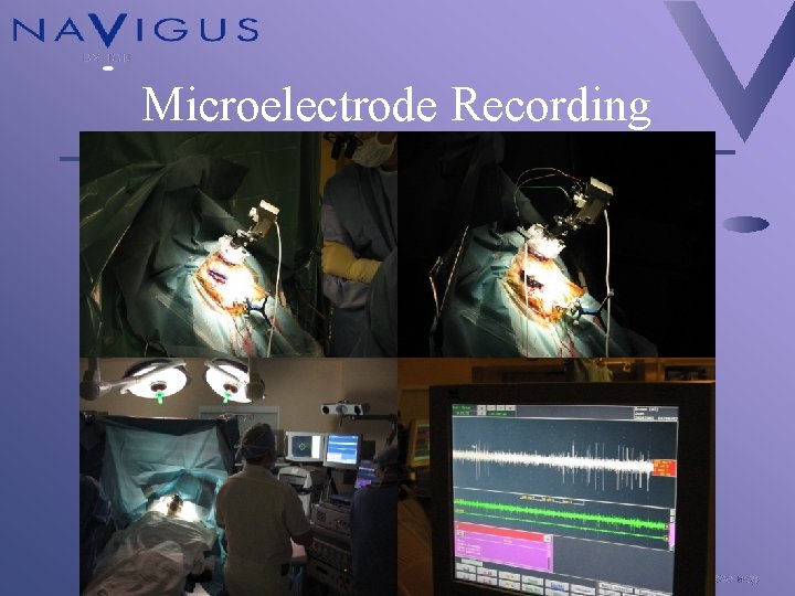 Microelectrode Recording Using the FHC microdrive Microelectrode Recording