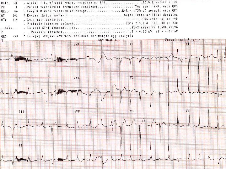 ARRHYTHMIAS IN ACUTE MYOCARDIAL INFARCTION CCU MANAGEMENT K