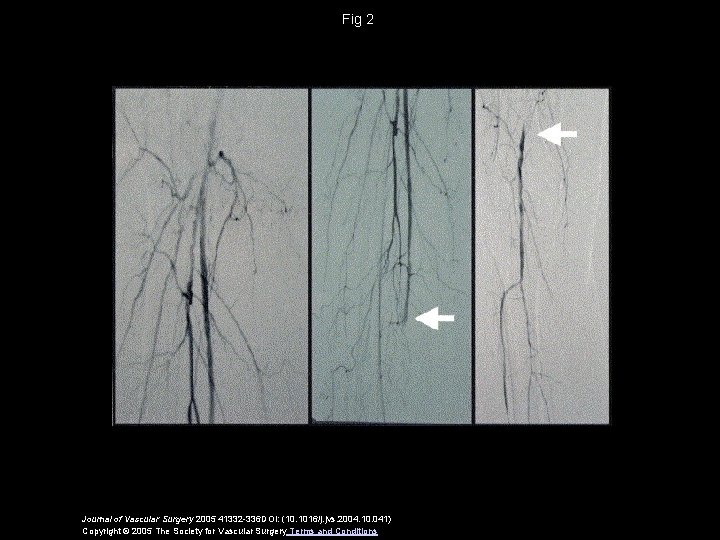 Endovascular native vessel recanalization to maintain limb perfusion