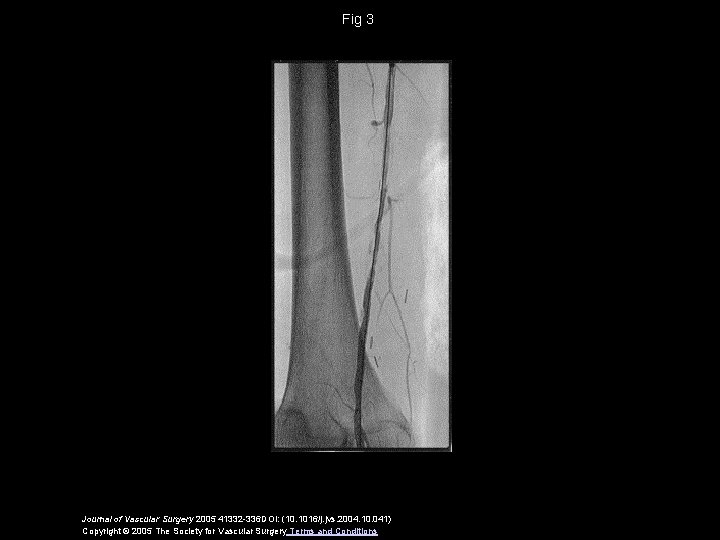 Endovascular native vessel recanalization to maintain limb perfusion