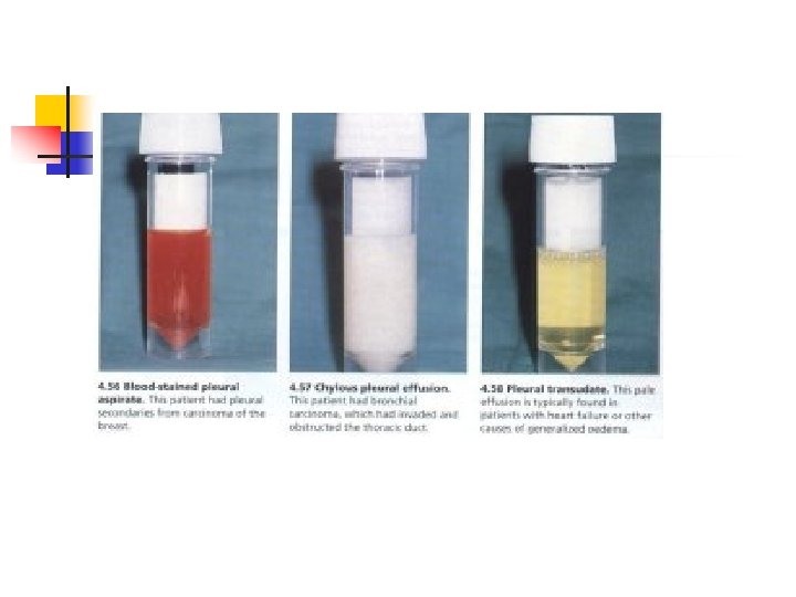 Abdominal and Thoracic Effusions Clinical Pathology Abdominalthoracic ...