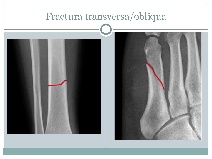 Fractures Fractura pathologica Myeloma The plasma membrane of