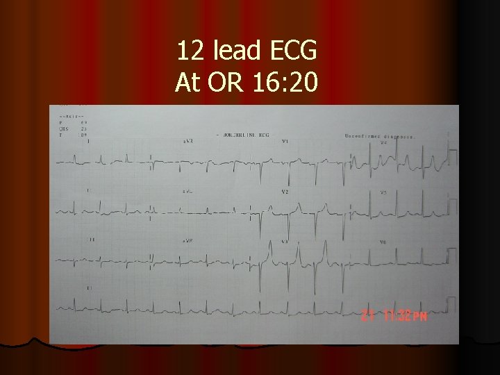 Acute Pulmonary Edema During Emergence from Anesthesia Liu