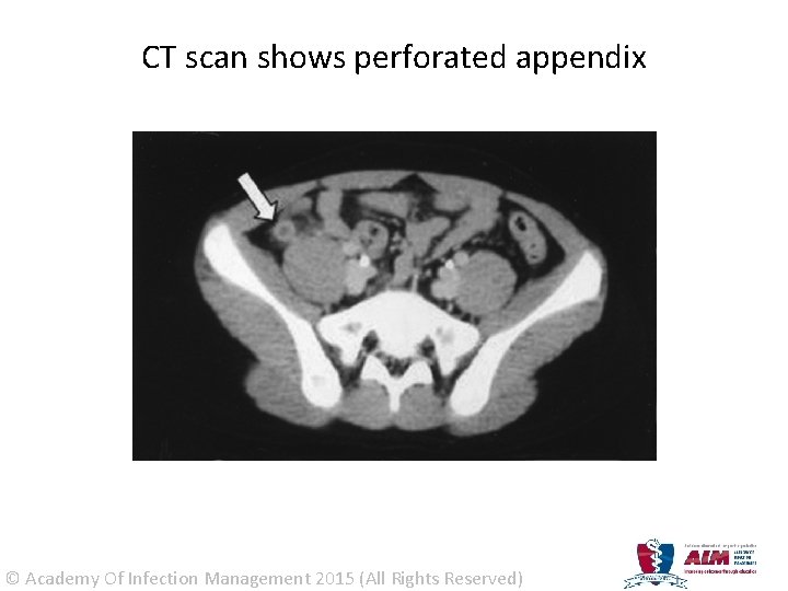 CASE STUDY A SUDDEN ONSET OF STOMACH PAIN