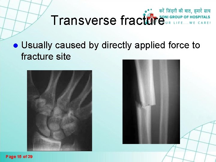 Fractures and Bone Healing Page 1 of 39