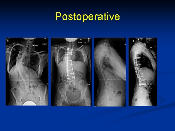 What Every Spine Surgeon Should Know About Neurosurgical