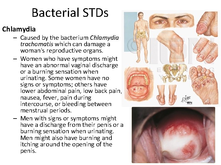 STDs and Contraceptives STDs Sexually Transmitted Disease STD