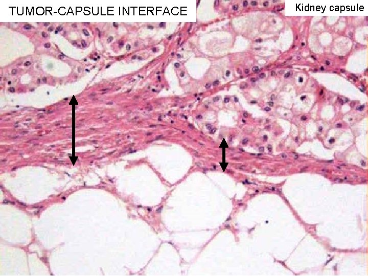 67 years old man Asymptomatic left solid renal
