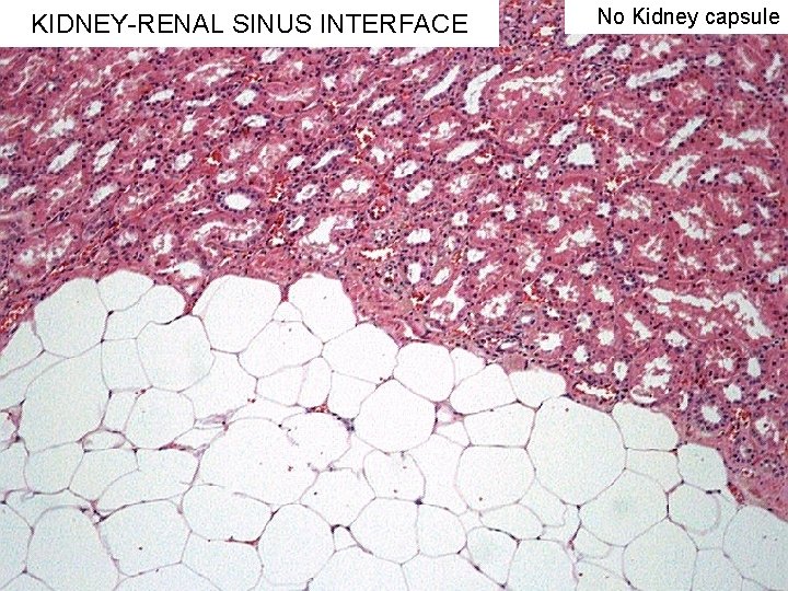 67 years old man Asymptomatic left solid renal