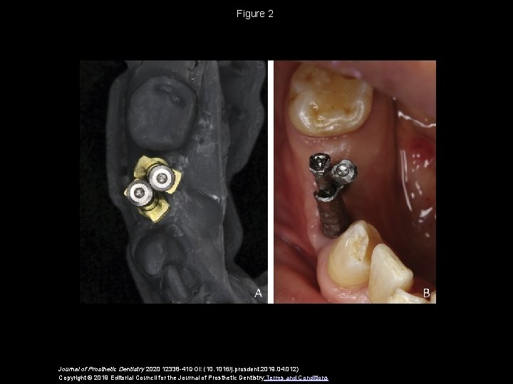 Selective implant scan body modification to restore severely