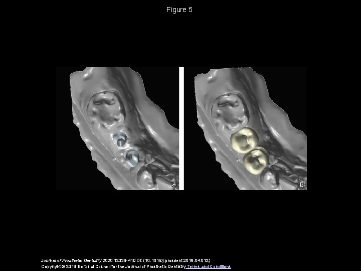 Selective implant scan body modification to restore severely