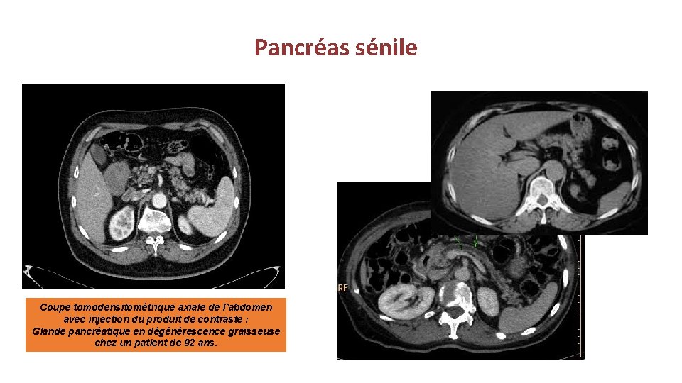 Radio anatomie normale du pancras ses variantes et