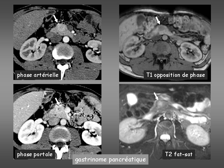 TUMEURS ENDOCRINES PANCRATIQUES circonstances de dcouverte et stratgie