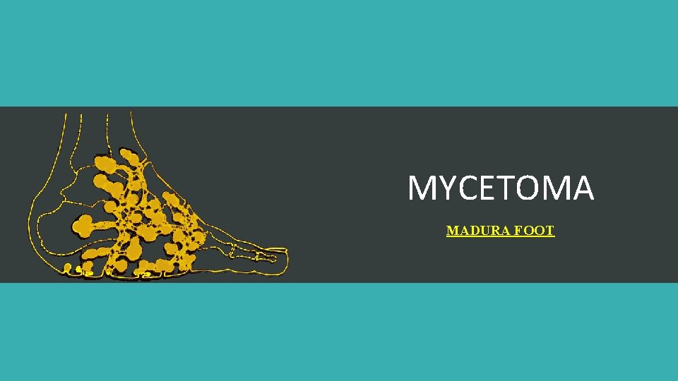 MYCETOMA MADURA FOOT Chronic localized subcutaneous mycotic infection
