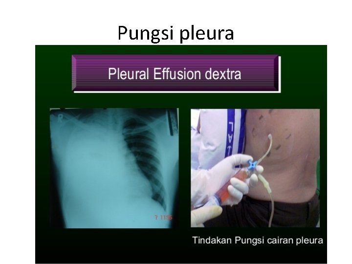 Lung Cancer Management Faster DIAGNOSIS improves SURVIVAL dr