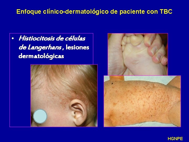 Enfoque clnicodermatolgico de paciente con TBC Prof Dra