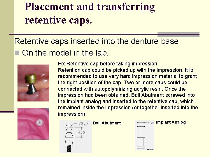 Almitech Implant System for implant retained overdentures l