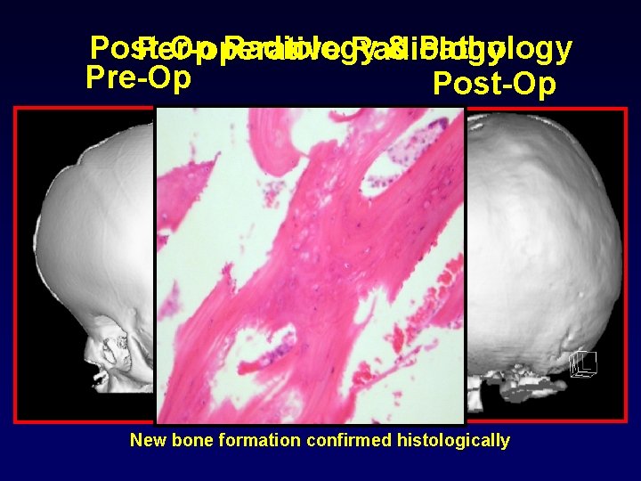 Managing Intracranial Hypertension in Syndromic Craniosynostosis A Report