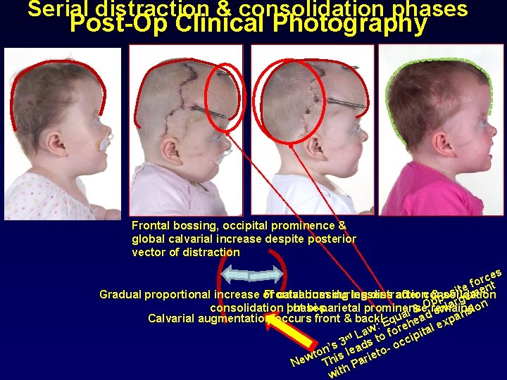 Managing Intracranial Hypertension in Syndromic Craniosynostosis A Report
