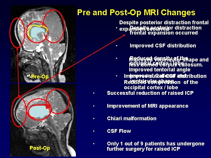 Managing Intracranial Hypertension in Syndromic Craniosynostosis A Report