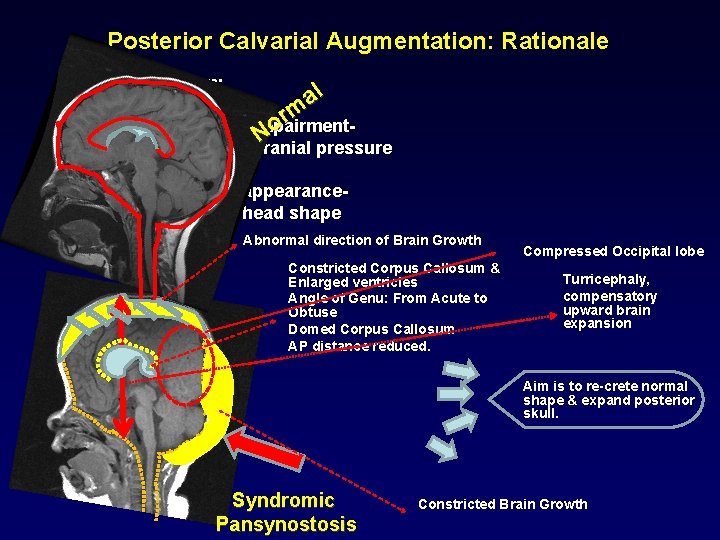 Managing Intracranial Hypertension in Syndromic Craniosynostosis A Report