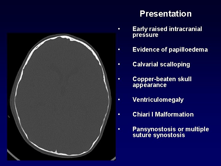Managing Intracranial Hypertension in Syndromic Craniosynostosis A Report