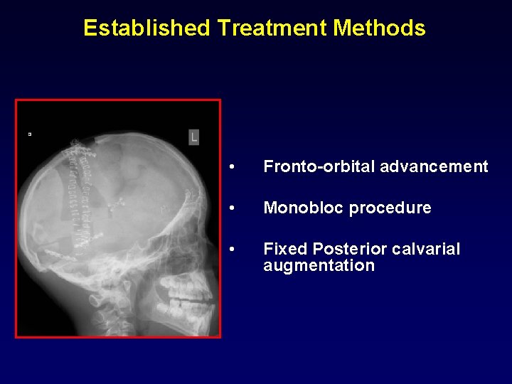 Managing Intracranial Hypertension in Syndromic Craniosynostosis A Report
