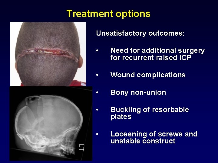 Managing Intracranial Hypertension in Syndromic Craniosynostosis A Report