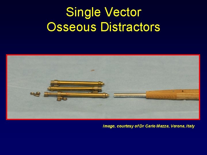 Managing Intracranial Hypertension in Syndromic Craniosynostosis A Report