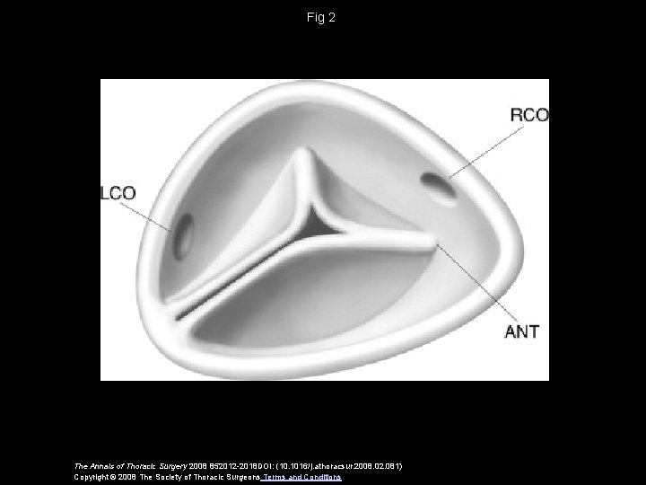Bicuspidization of the Unicuspid Aortic Valve A New