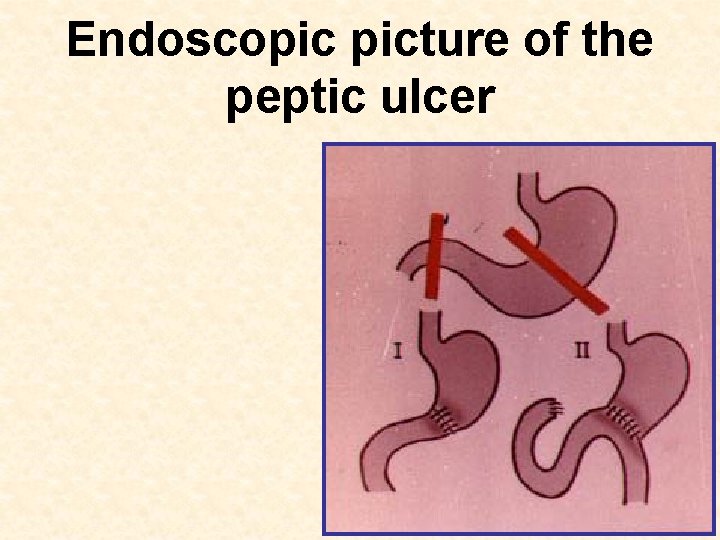 PEPTIC ULCER AGGRESSIVE FACTORS hydrochloric acid pepsin reverse