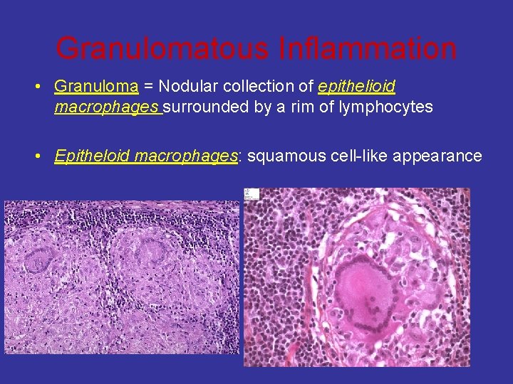 Granulomatous inflammation Granulomatous inflammation A granuloma is a