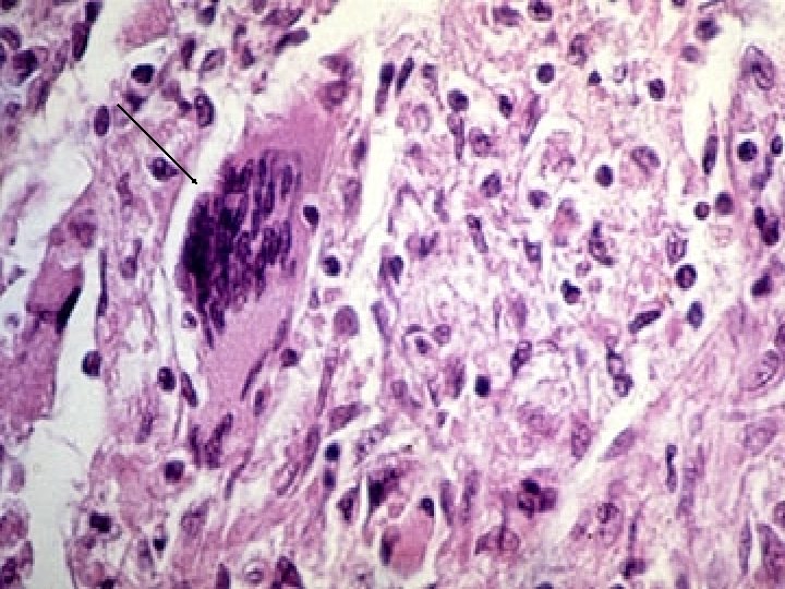 Granulomatous inflammation Granulomatous inflammation A granuloma is a