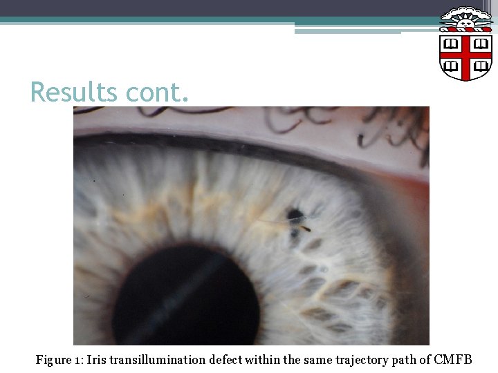 Metallic Foreign Body Embedded in the Posterior Lens