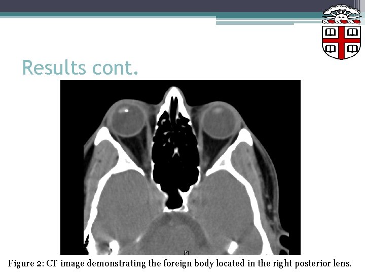 Metallic Foreign Body Embedded in the Posterior Lens
