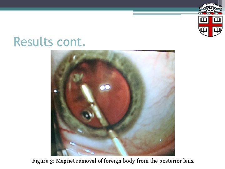 Metallic Foreign Body Embedded in the Posterior Lens